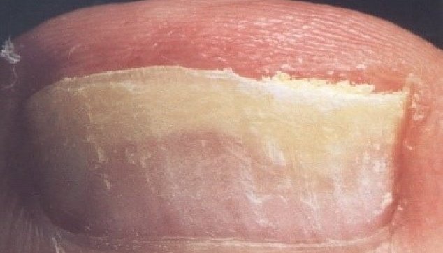 פטרת ציפורניים בידיים | טיפול בפטרת ציפורניים - פרופסור אבנר שמר